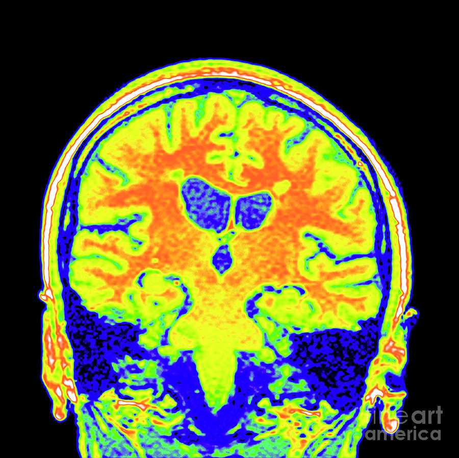 Multiple Sclerosis Brain Mri Photograph by Dr W. Crum, Dementia ...