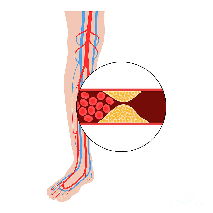 Peripheral Artery Disease Photograph By Pikovit Science Photo Library