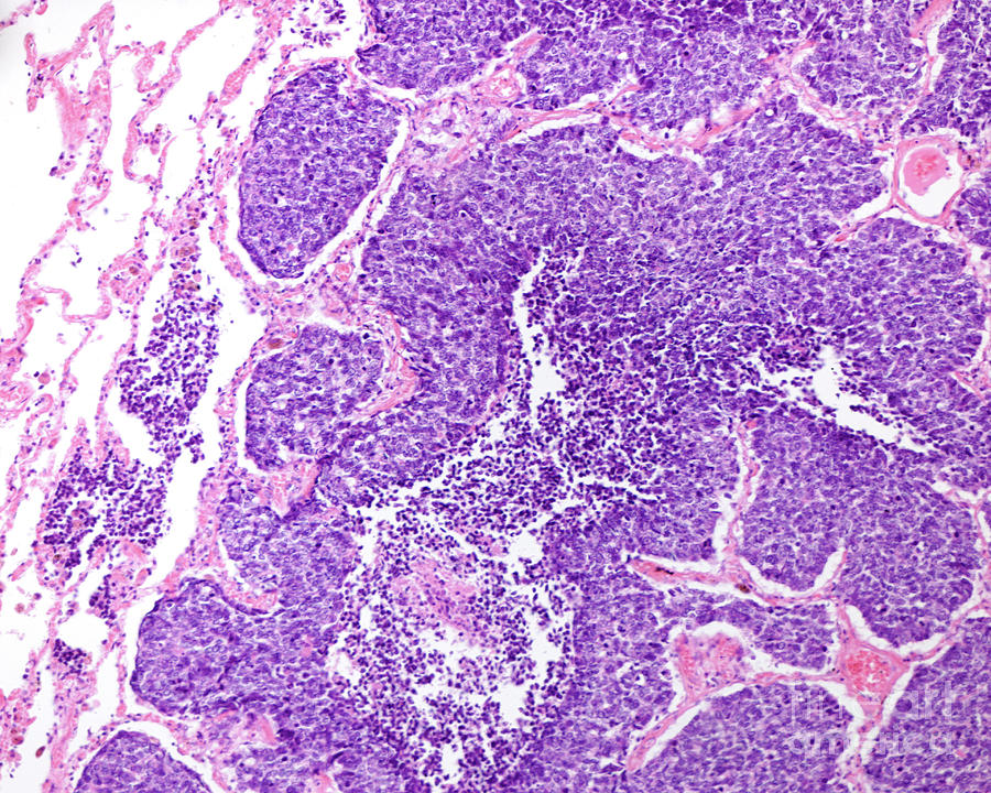 Small Cell Lung Carcinoma 2 By Jose Calvo Science Photo Library