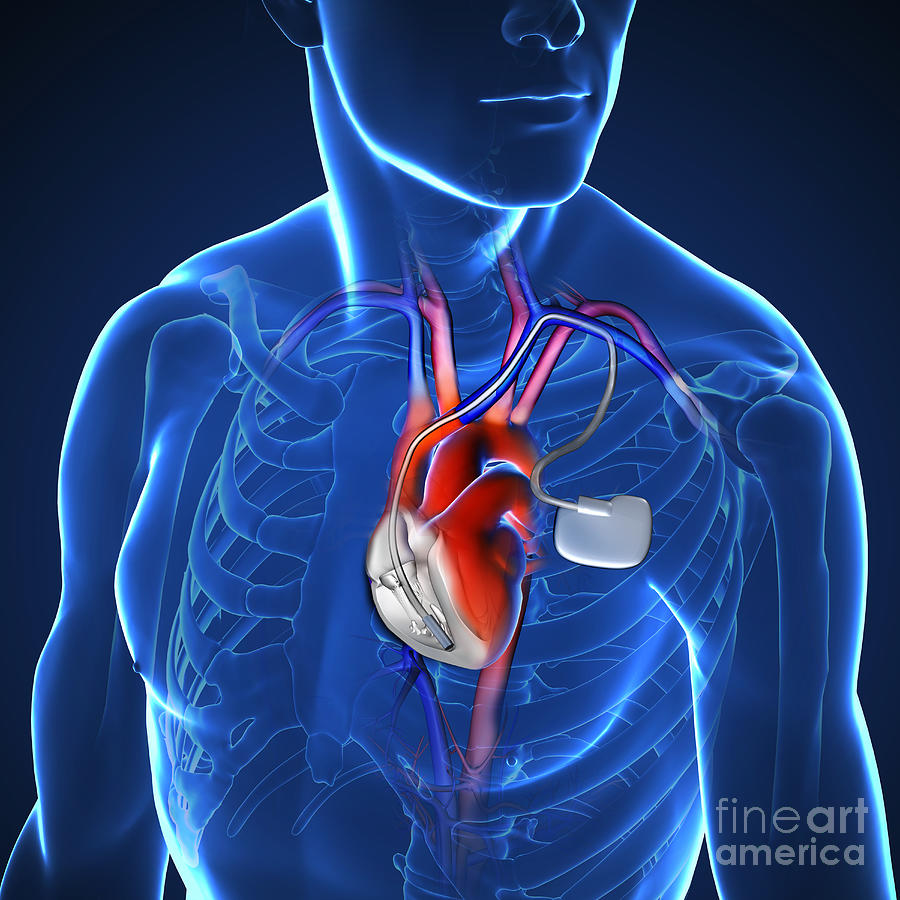 Pacemaker Photograph by Fernando Da Cunha/science Photo Library - Fine ...