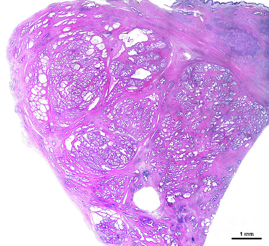 Benign Prostatic Hyperplasia Photograph By Jose Calvo Science Photo