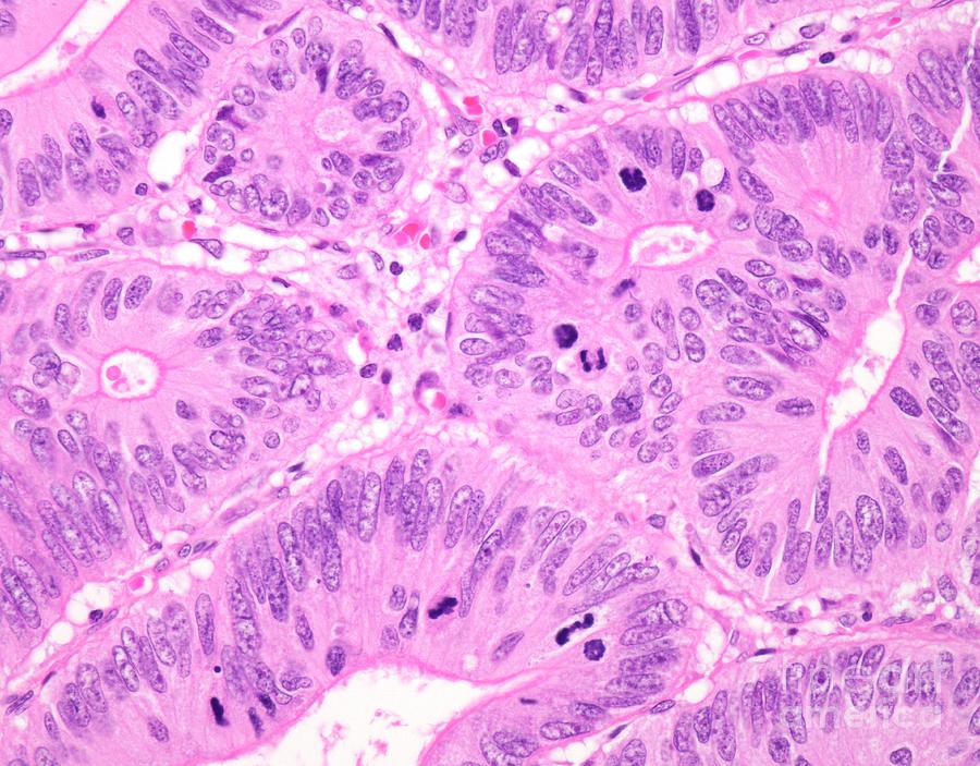 Colon Cancer In A Polyp Photograph By Webpathology Science Photo Library