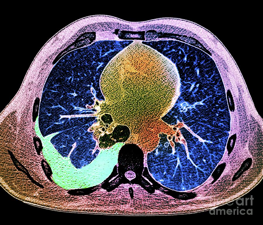 Internal Bleeding In Pleural Cavity #3 by Science Photo Library