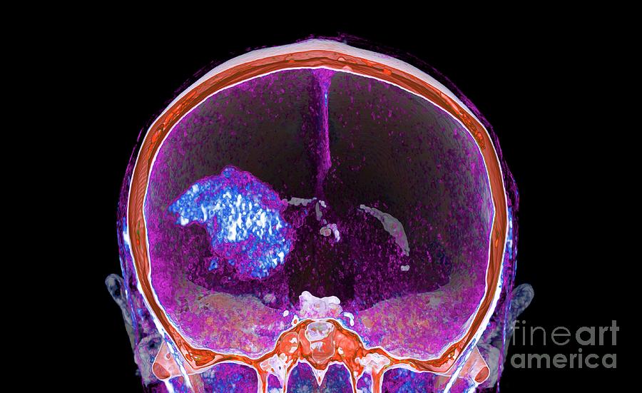 Intraparenchymal Haemorrhage Photograph by Vsevolod Zviryk/science ...