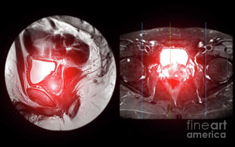 Prostate Cancer #3 by Samunella/science Photo Library