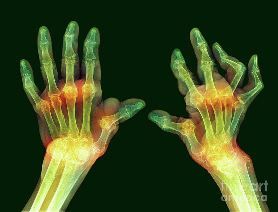 Rheumatoid Arthritis Of The Hands Photograph by Science Photo Library