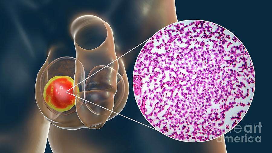 Testicular Cancer 30 By Kateryna Kon Science Photo Library