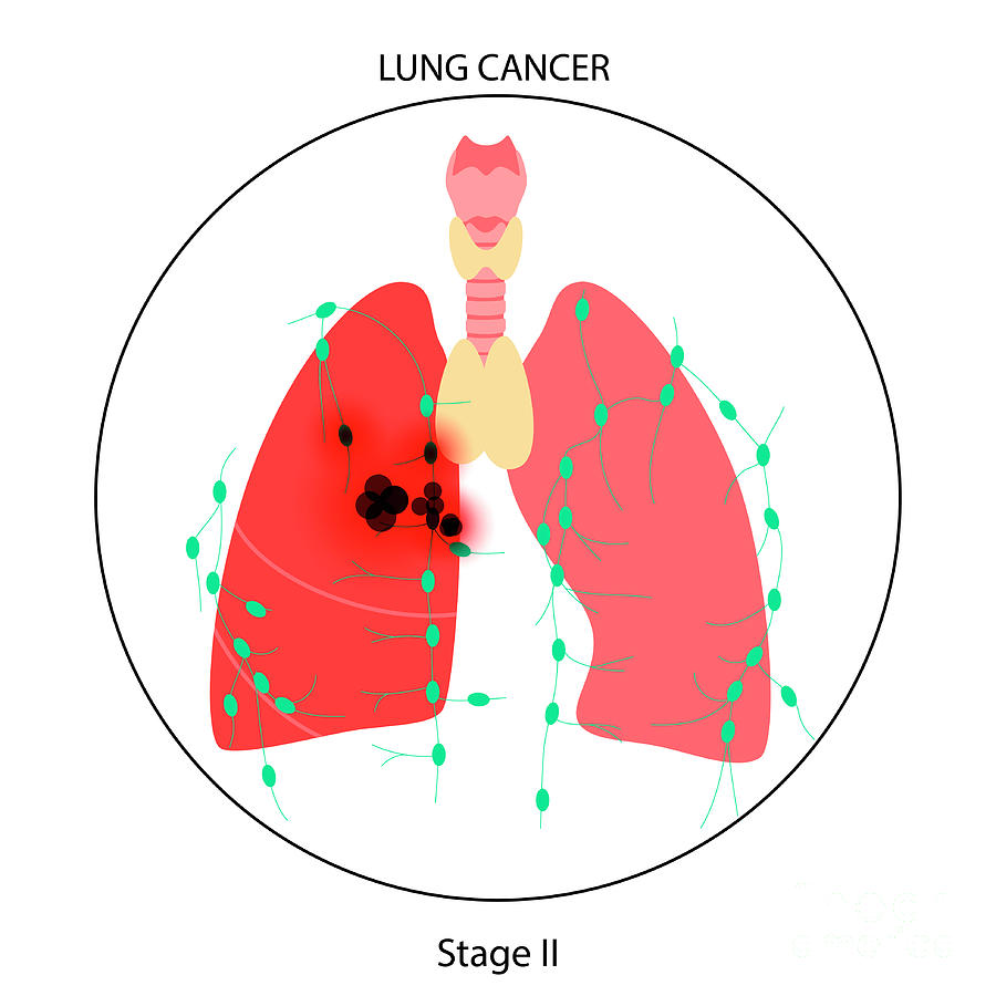 Stage 2 Of Lung Cancer