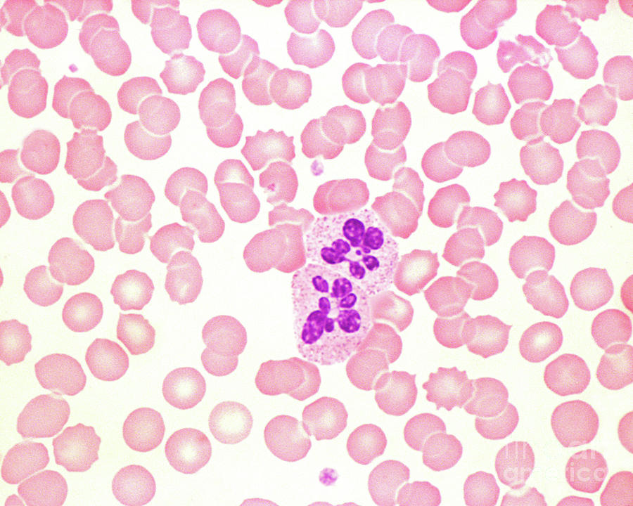 Neutrophil Hypersegmentation #4 Photograph by Science Photo Library ...