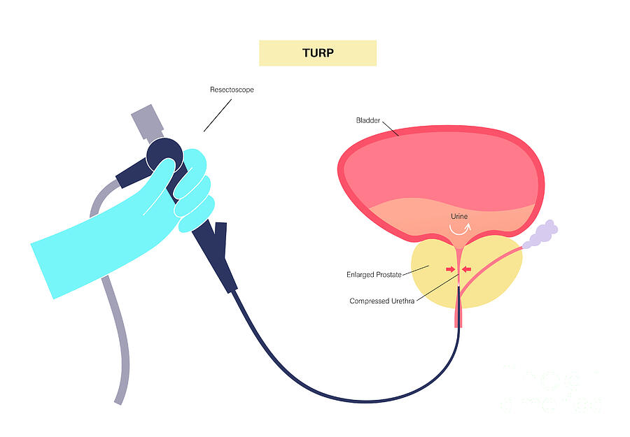 Transurethral Resection Of Prostate #4 by Pikovit / Science Photo Library