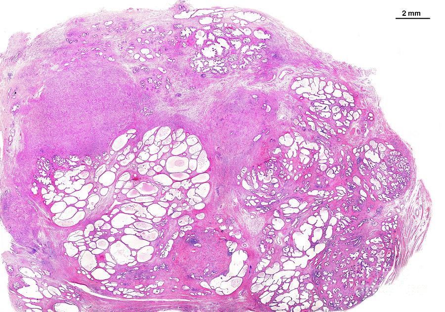 Benign Prostatic Hyperplasia Photograph By Jose Calvo Science Photo