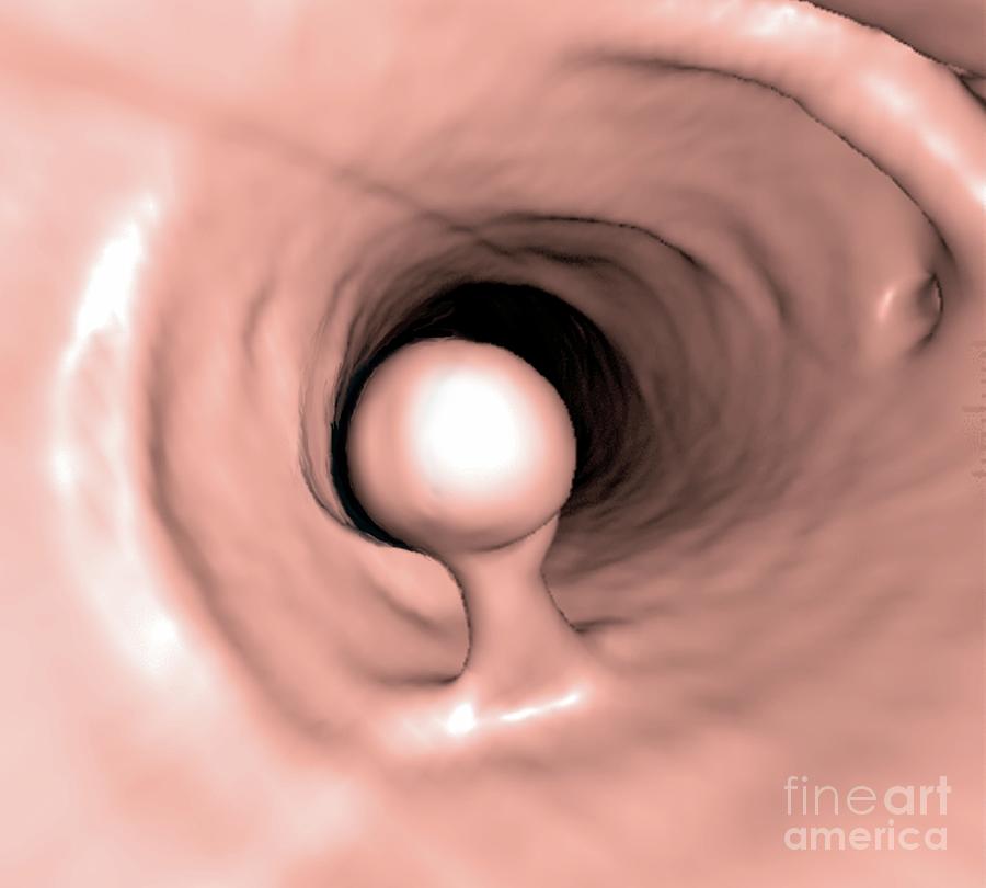 Colorectal Polyp Photograph By Zephyr Science Photo Library Fine Art