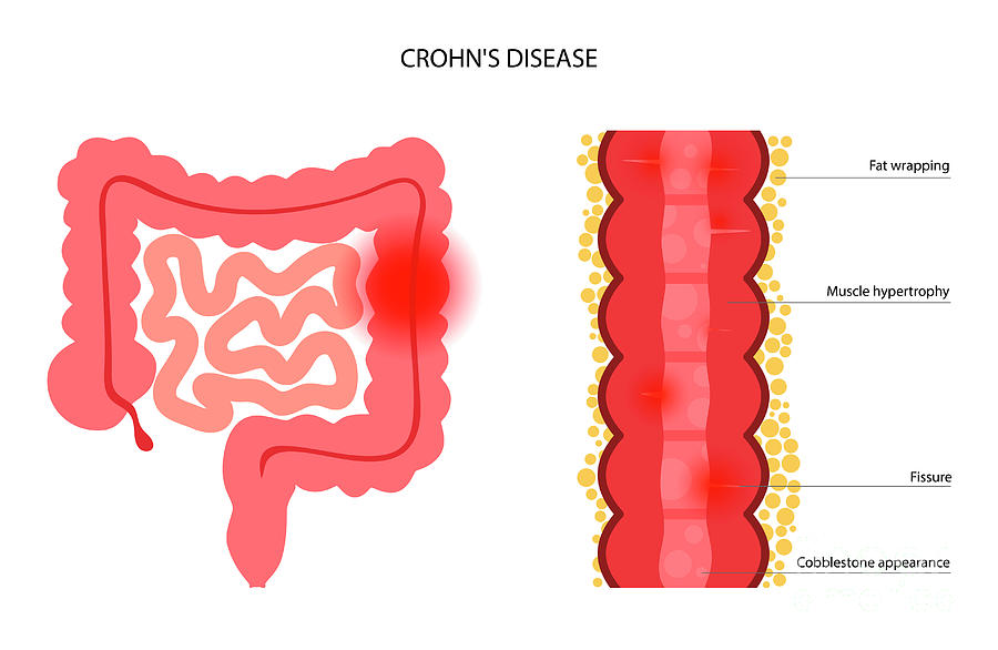 Crohns Disease Photograph By Pikovit Science Photo Library Pixels