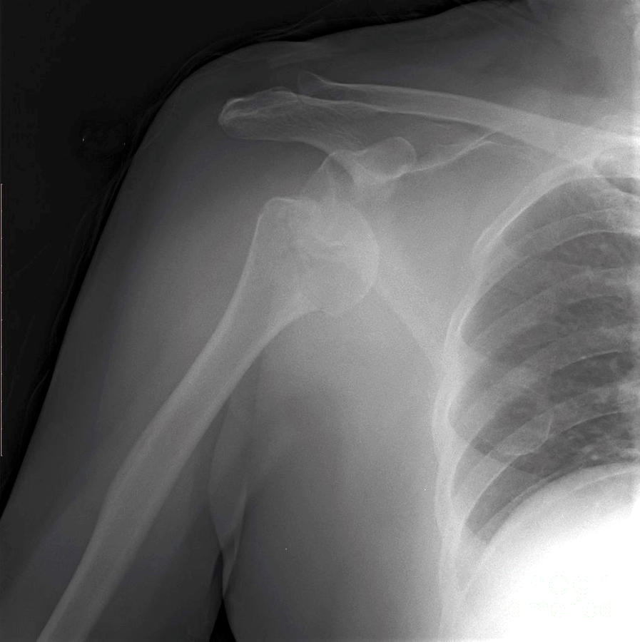 Dislocated Right Shoulder #5 by Science Photo Library