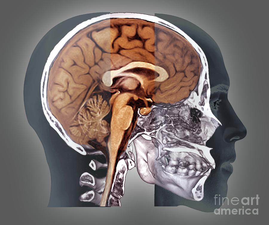 Human Skull And Brain Photograph by Zephyr/science Photo Library - Fine ...