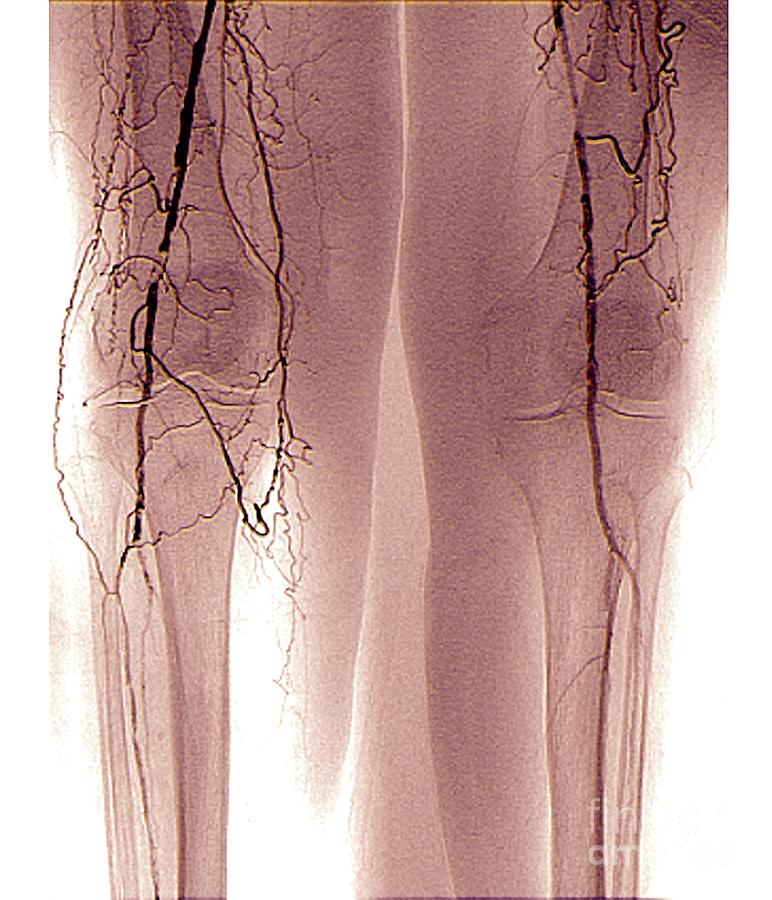 Nearly Blocked Femoral Arteries Photograph by Zephyr/science Photo Library - Fine Art America