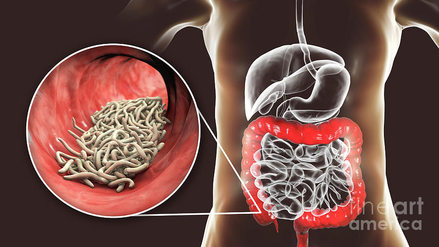 Round Worms In Human Large Intestine #5 Photograph by Science Photo ...
