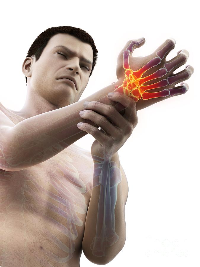 Wrist Pain Photograph by Sebastian Kaulitzki/science Photo Library - Pixels