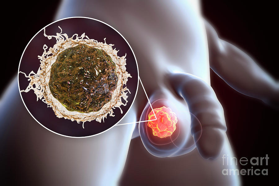 Testicular Cancer Photograph By Kateryna Kon Science Photo Library Pixels