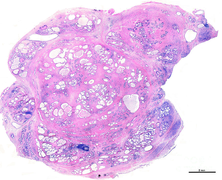 Benign Prostatic Hyperplasia Photograph By Jose Calvo Science Photo Library