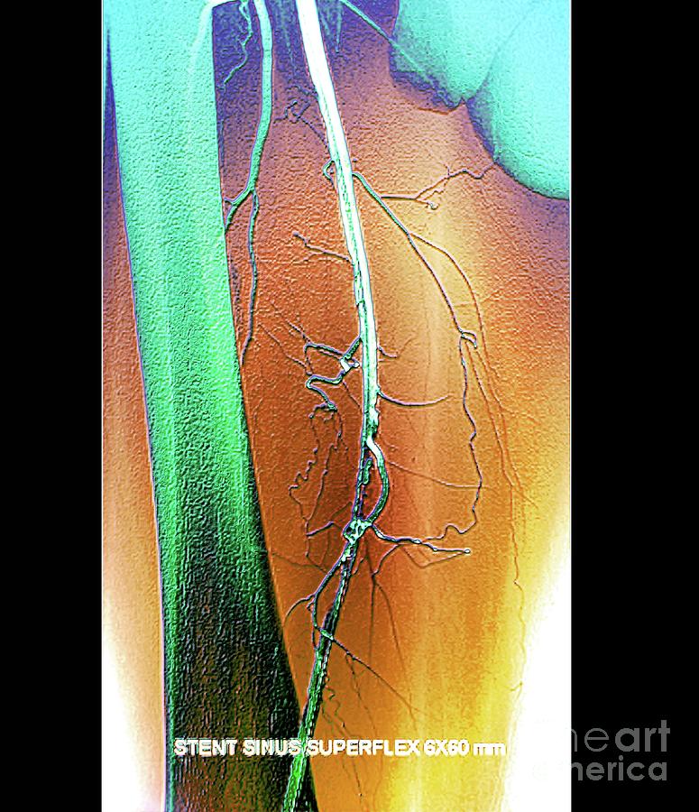Leg Artery Angioplasty Photograph by Zephyr/science Photo Library - Pixels