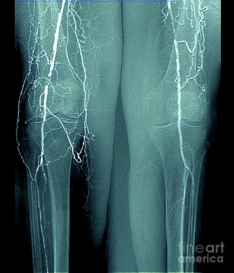 Nearly Blocked Femoral Arteries #7 Photograph by Science Photo Library - Fine Art America