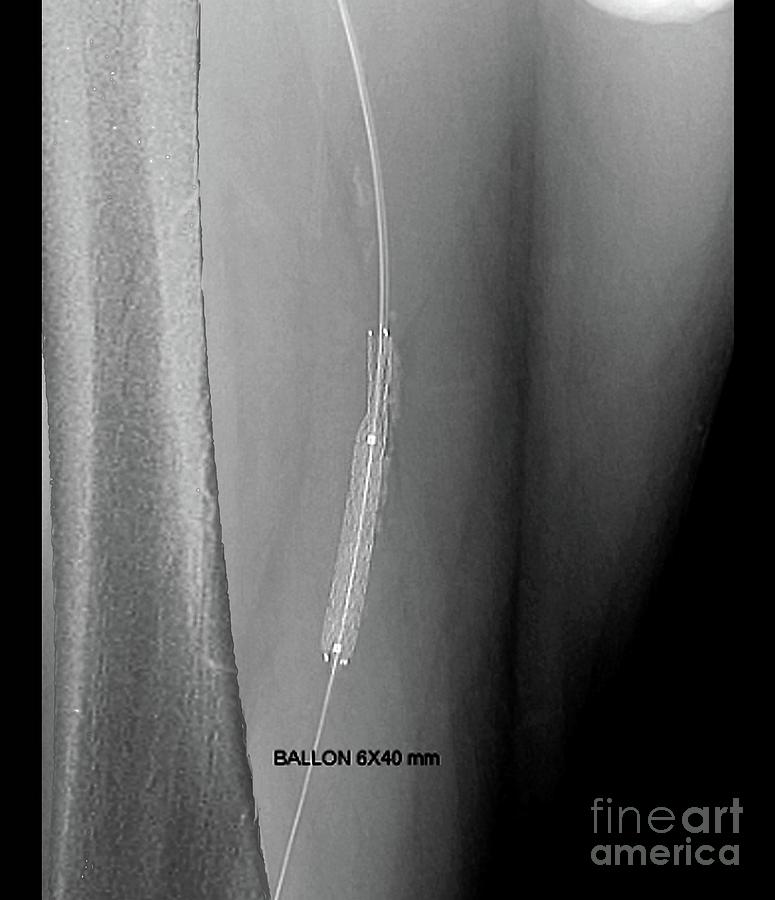 Leg Artery Angioplasty Photograph by Zephyr/science Photo Library