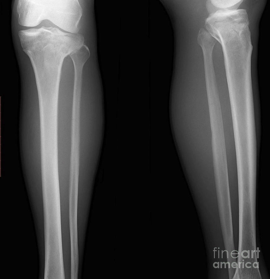 Tibial Plateau Fracture Photograph By Rajaaisyascience Photo Library Fine Art America