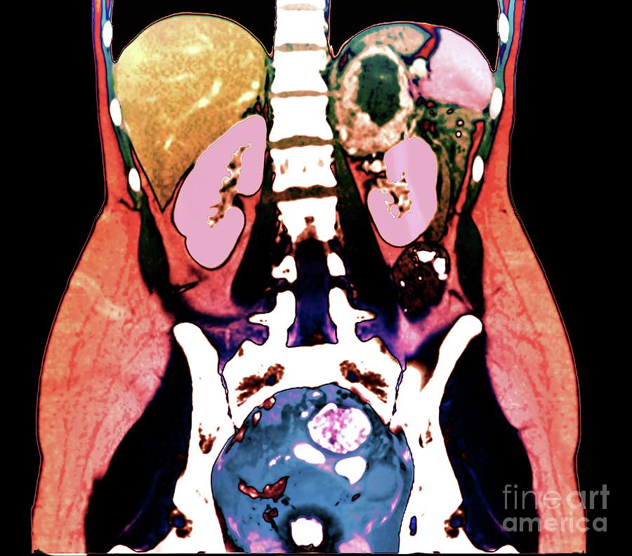 Adrenal Gland Cancer Photograph By Zephyrscience Photo Library Pixels