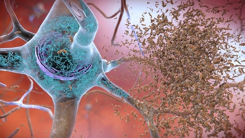 Alzheimers Disease Beta-amyloid Plaques Photograph by Science Source - Fine Art America