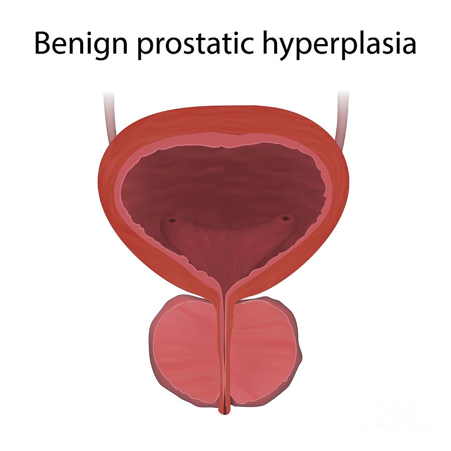 Benign Prostatic Hyperplasia Photograph By Veronika Zakharova Science