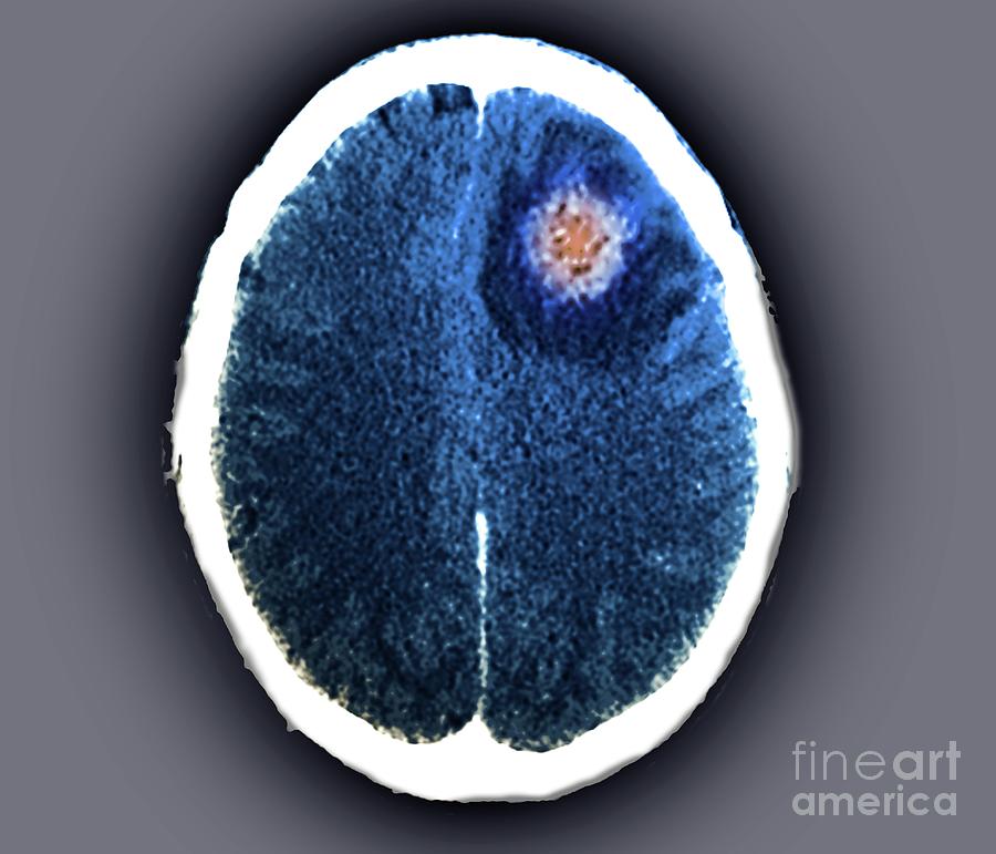 Brain Abscess Photograph By Zephyrscience Photo Library Pixels