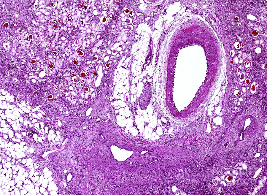 Clear Cell Renal Cell Carcinoma by Science Photo Library