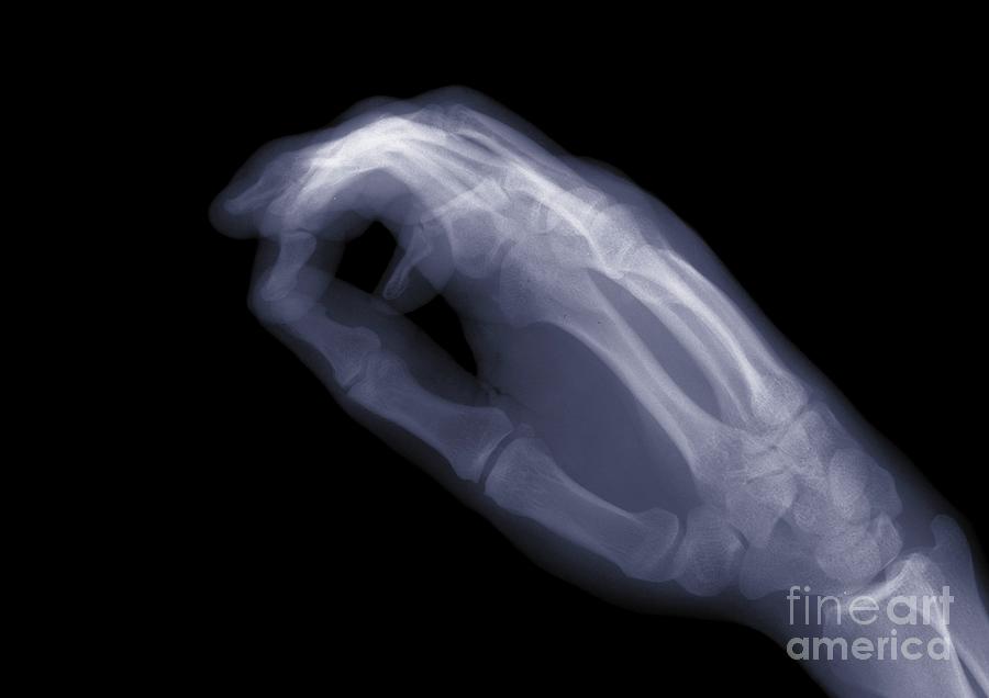 Closed Hand Photograph by Nick Veasey/science Photo Library