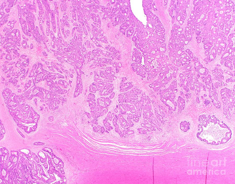 Colon Cancer In A Polyp Photograph By Webpathology Science Photo Library
