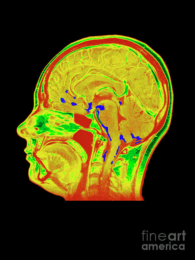 Coloured Mri Scan Of Human Brain With Meningitis Photograph by Simon Fraser/royal Victoria ...