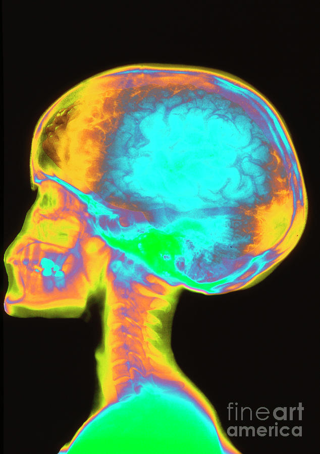 Coloured X-ray Of Human Skull Photograph by Mehau Kulyk/science Photo ...