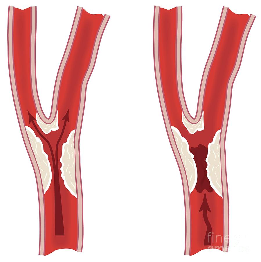 Constricted Carotid Arteries Photograph by Jeanette Engqvist/science ...