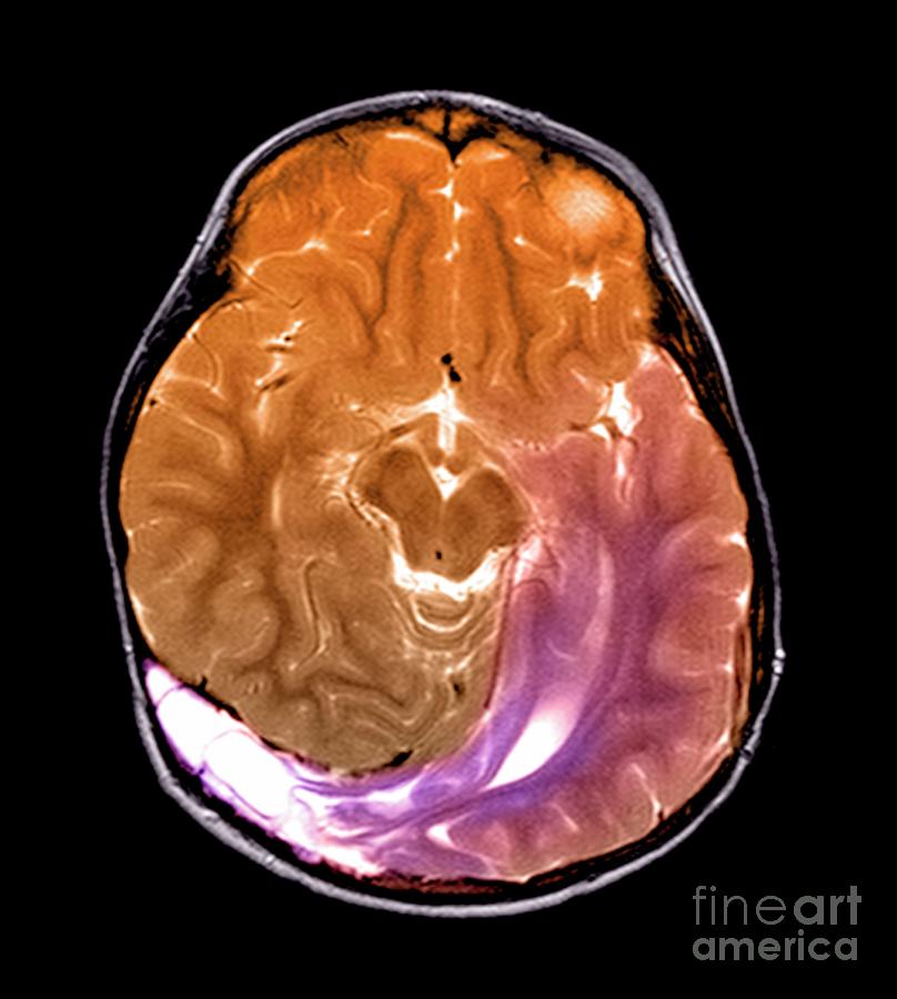 Deformed Head by Science Photo Library