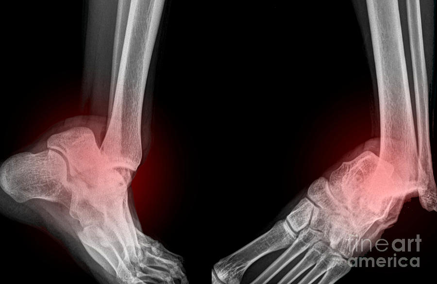 Dislocated Ankle Photograph by Rajaaisya/science Photo Library | Pixels