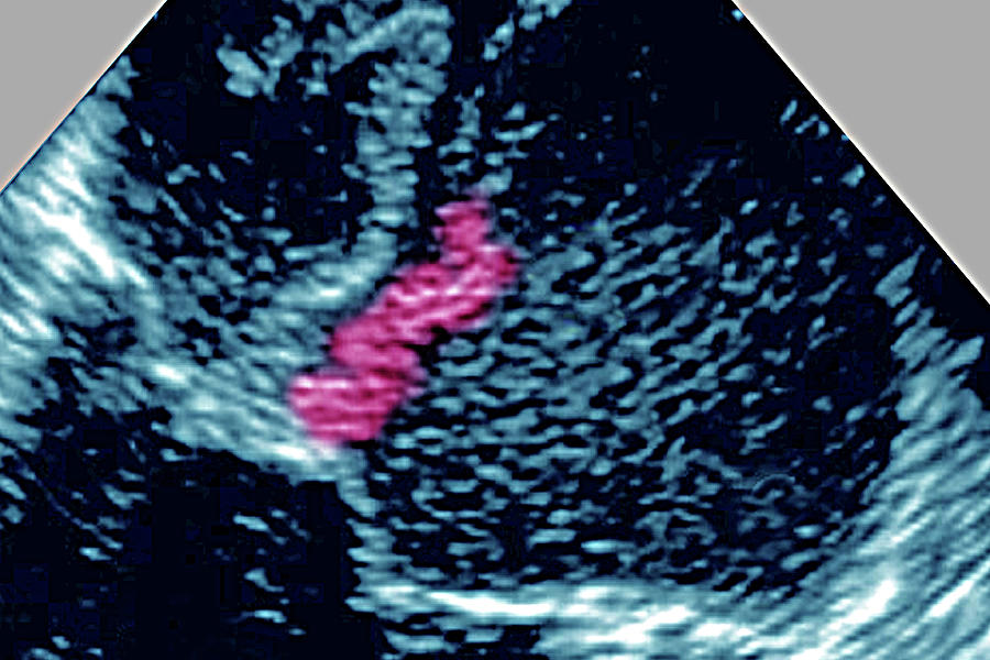 Endocarditis Photograph by James Cavallini - Fine Art America Endocarditis Photograph by James Cavallini - Fine Art America
