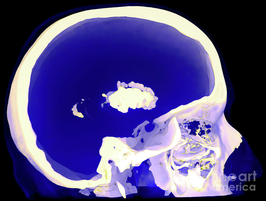 Fahr Syndrome Photograph by Vsevolod Zviryk/science Photo Library ...