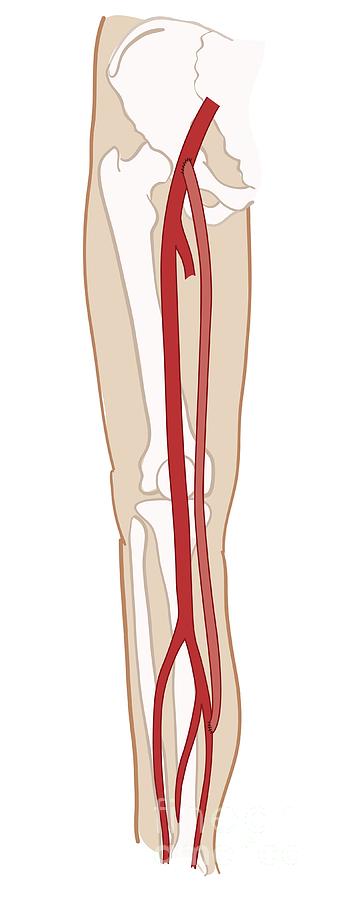 Femoropoplitea Bypass In Leg Photograph By Jeanette Engqvistscience Photo Library Fine Art