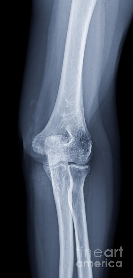 Healthy Elbow Joint by Science Photo Library