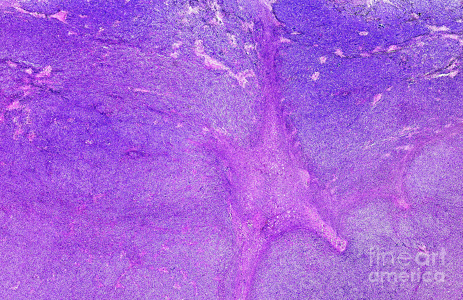 Human Testicular Seminoma Photograph By Nigel Downer Science Photo