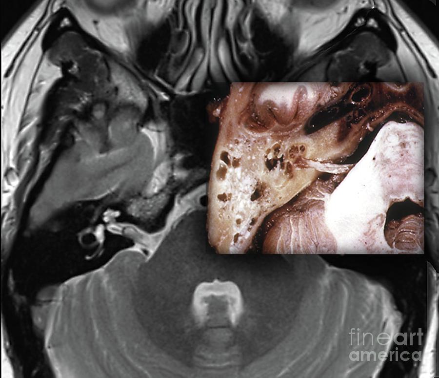 Inner Ear Structures Photograph by Zephyr/science Photo Library - Pixels