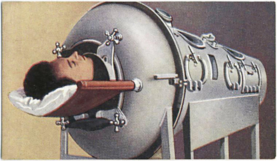 Iron Lung Trading Card Photograph By Science Source Fine Art America