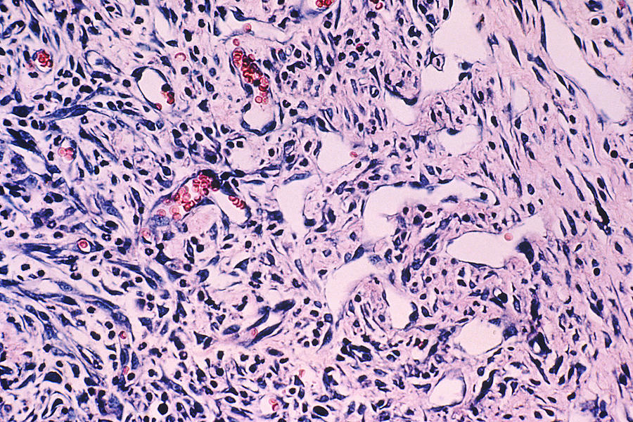 Light Micrograph Of Kaposi Sarcoma Digital Art by Callista Images - Pixels Light Micrograph Of Kaposi Sarcoma Digital Art by Callista Images - Pixels