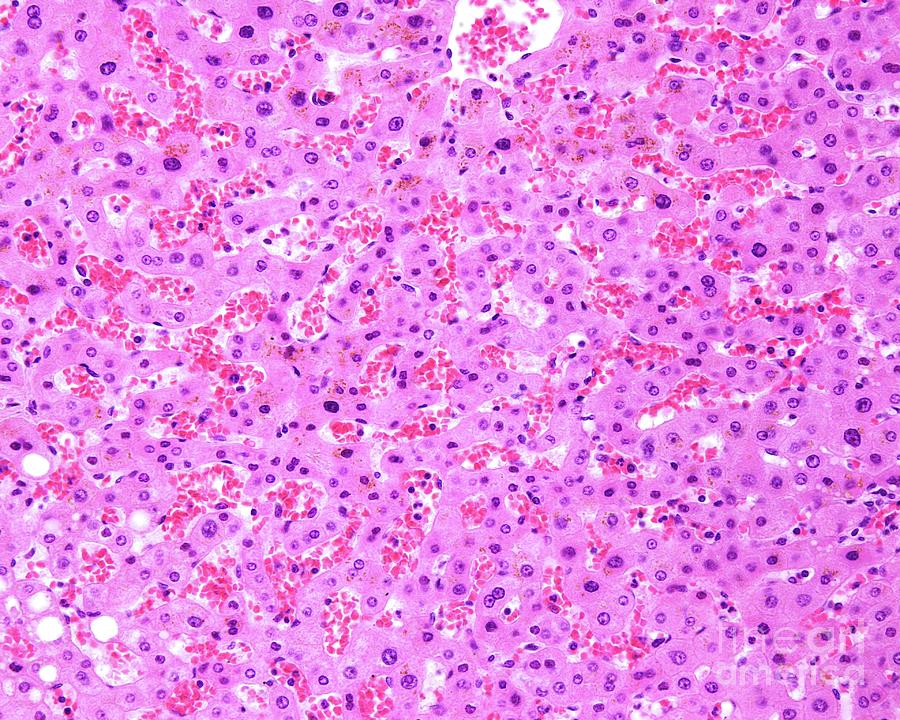 Liver Congestion Photograph by Jose Calvo / Science Photo Library | Pixels