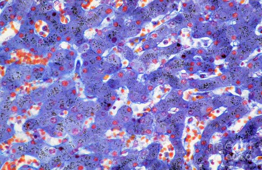 Lm Of Haemosiderosis Photograph by Astrid & Hanns-frieder Michler/science Photo Library - Pixels